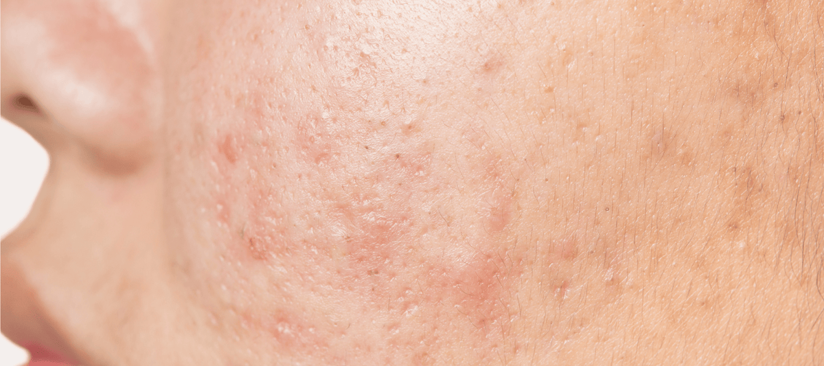 Understanding the Different Types of Acne on Your Face | The Pink Foundry