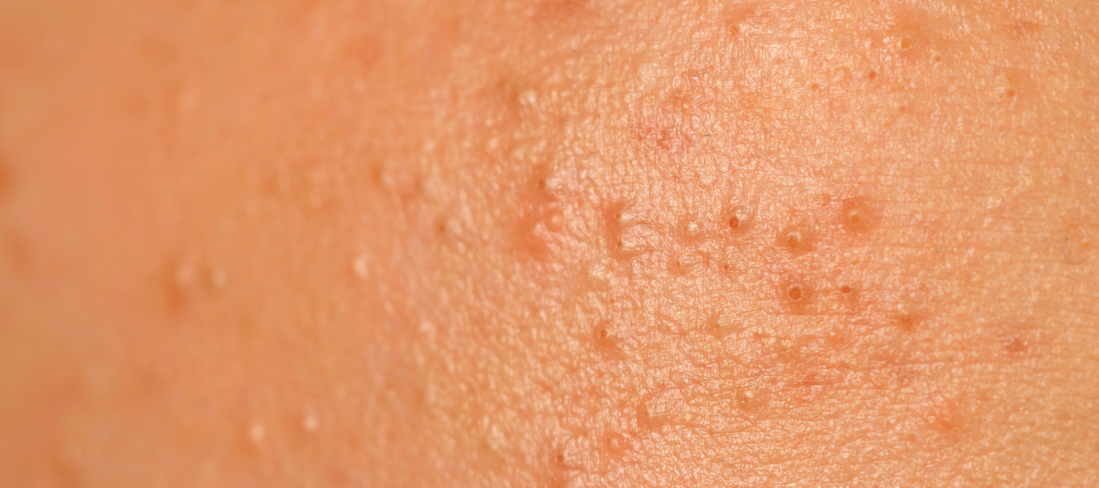 Different Types of Small Pimples and Effective Treatment | The Pink Foundry