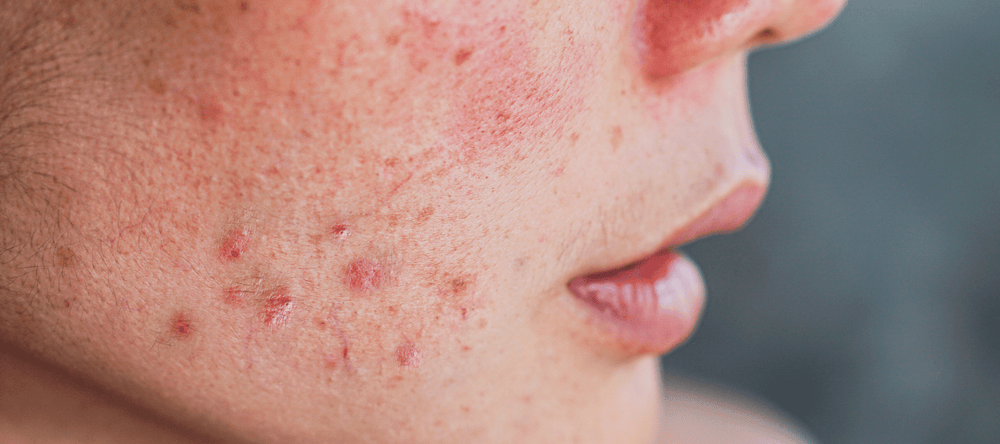 Papular Acne: Causes, Symptoms and Treatment | The Pink Foundry