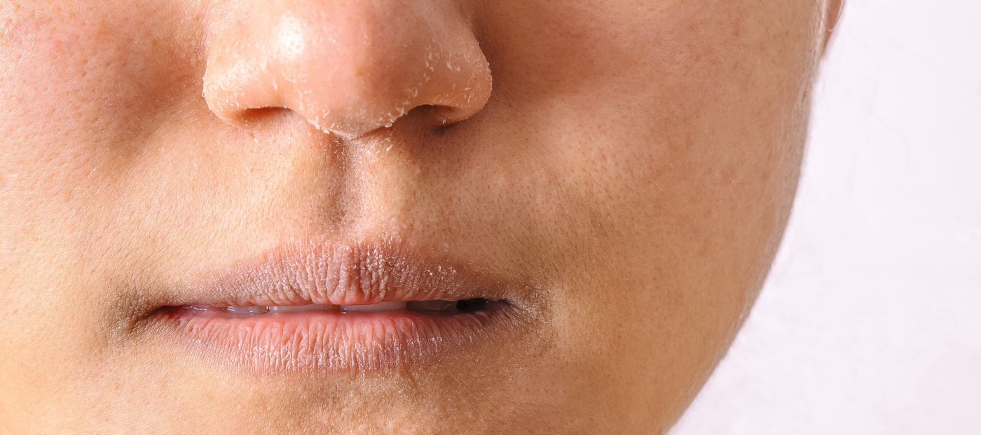 Winter Skin Problems - Navigating Common Skin Problems During the ...