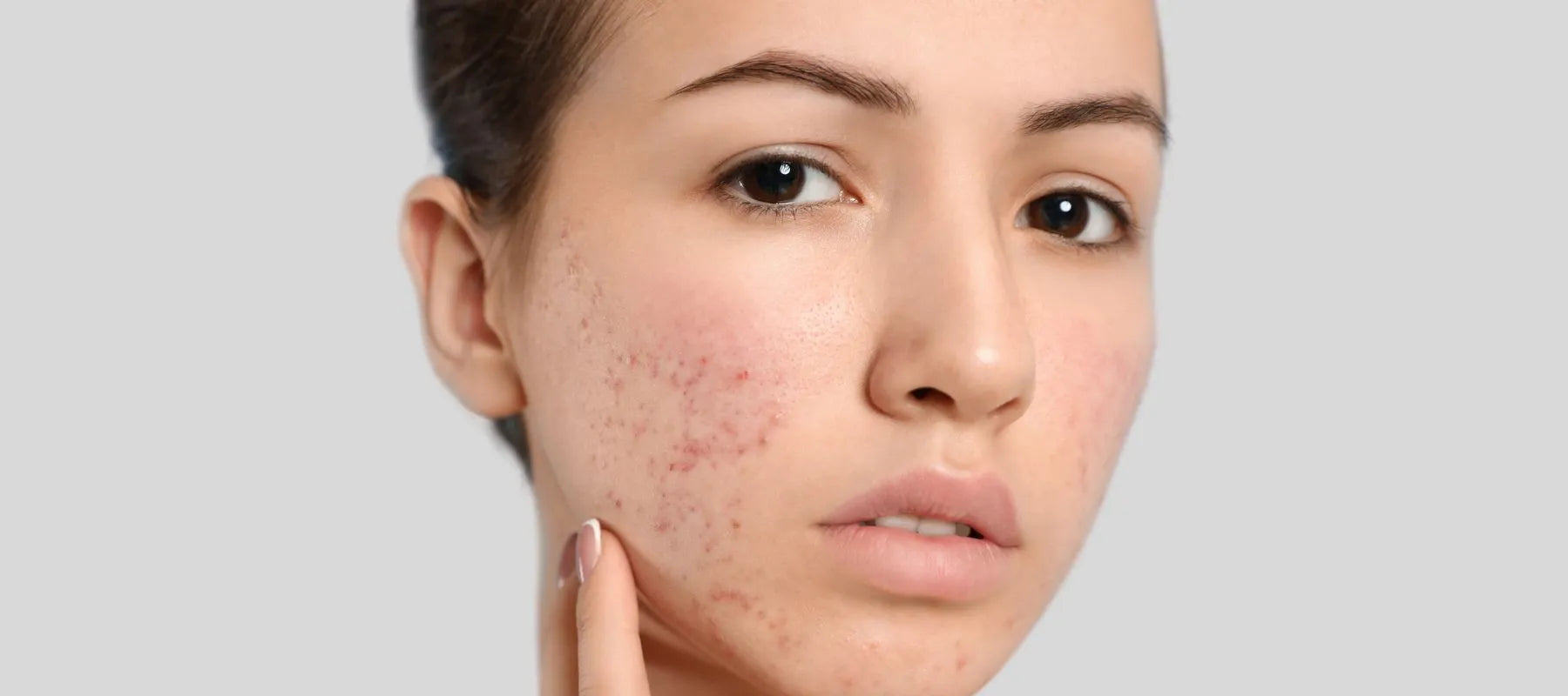 Zinc for Acne: Know is Zinc Good for Acne | The Pink Foundry