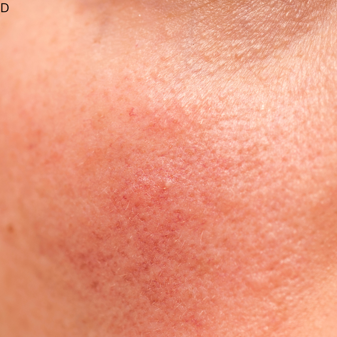 Damaged Skin Barrier