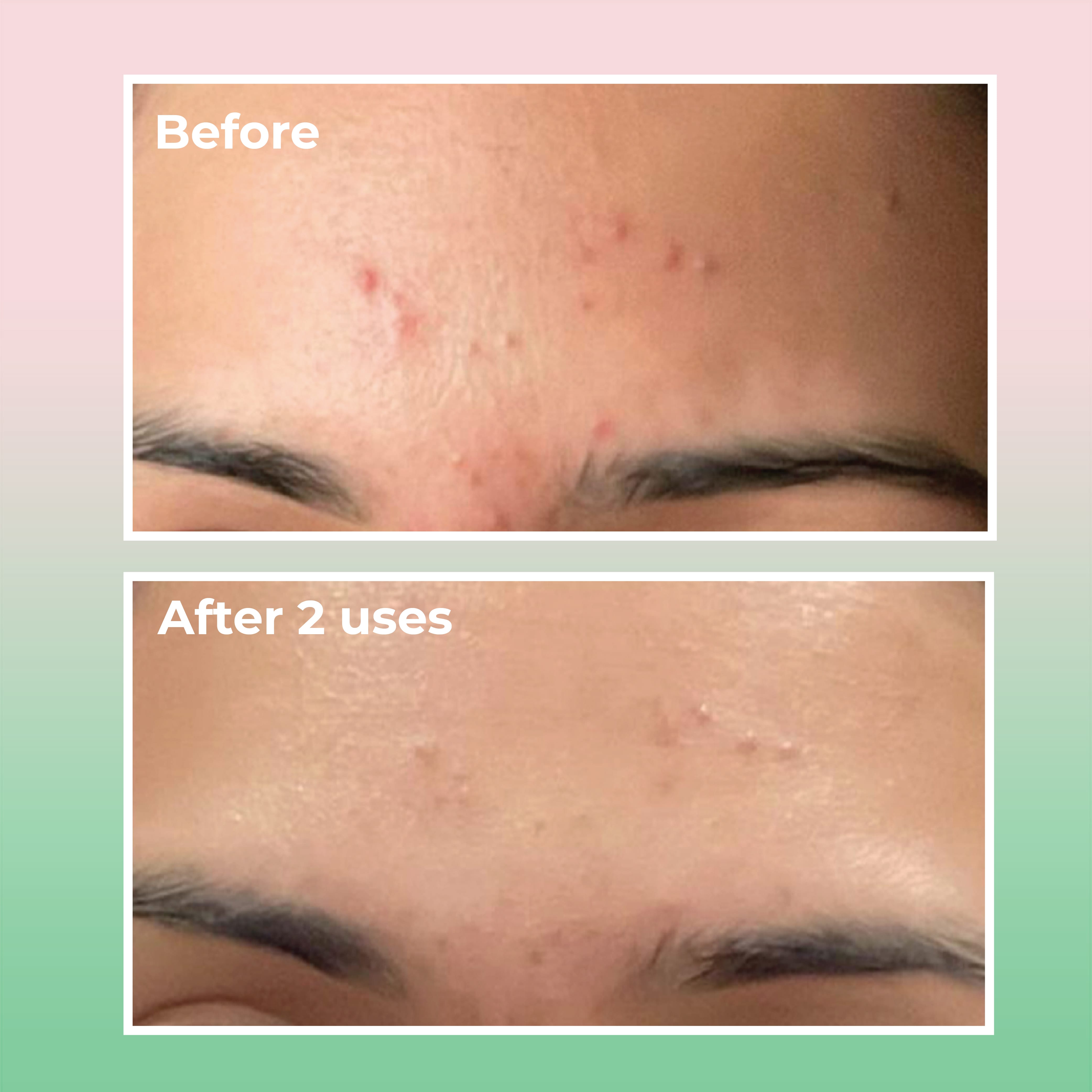 Spot Treatment for Acne Removal - Buy Overnight Acne Spot Corrector ...