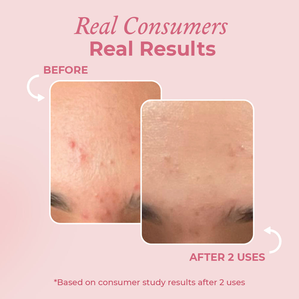 Acne Spot Treatment – Buy Overnight Acne Spot Corrector, Best Pimple ...